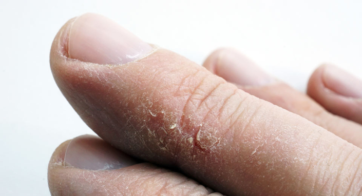 Rissige Fingerkuppen - Pulpitis sicca behandeln | ptaDirekt